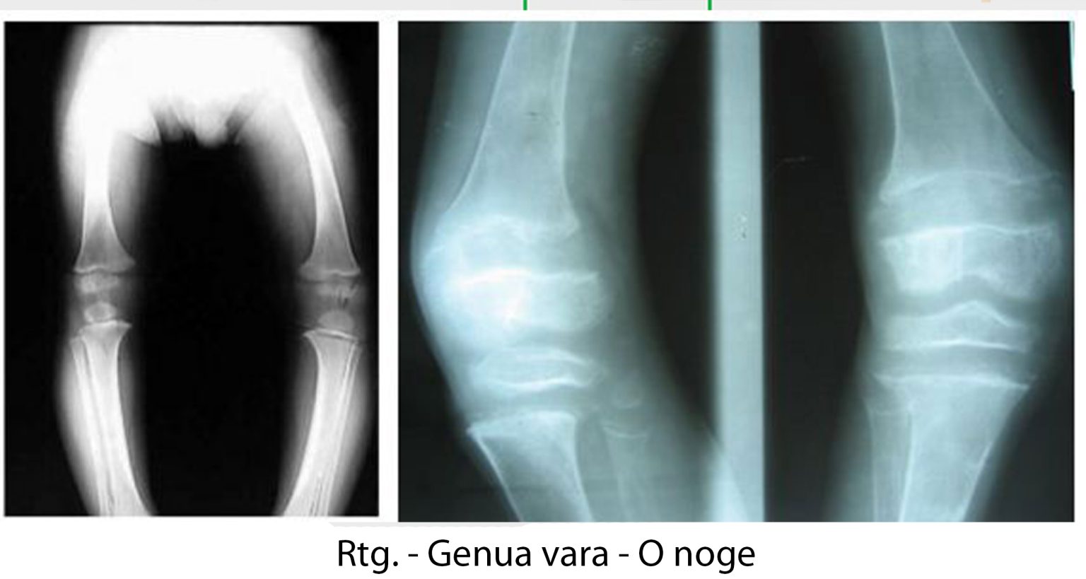 Deformiteti kolena – Uzroci, simptomi i mogućnosti lečenja